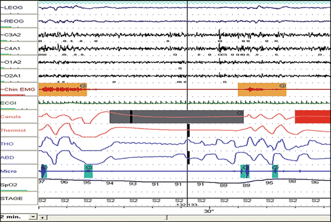 Polysomnography: An Overview | SpringerLink