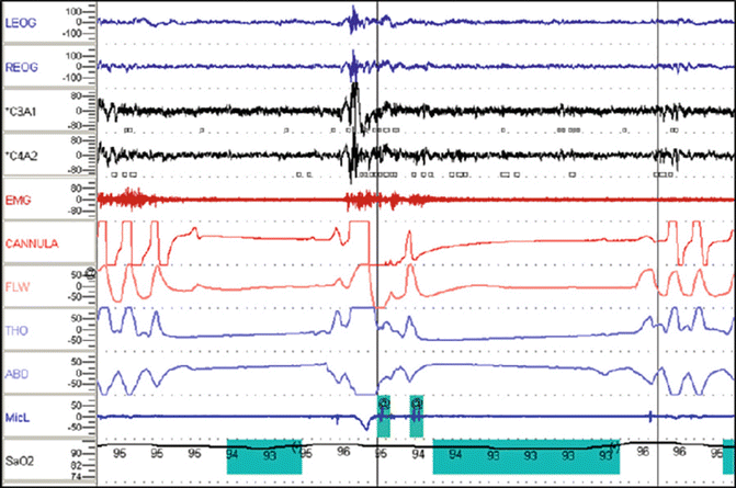 Polysomnography: An Overview | SpringerLink