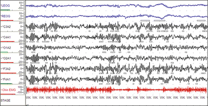 Polysomnography: An Overview | SpringerLink
