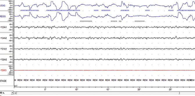 Polysomnography: An Overview | SpringerLink