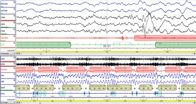 Polysomnography: An Overview | SpringerLink
