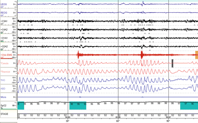 Polysomnography: An Overview | SpringerLink