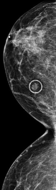 Mammography Techniques, Positioning, and Optimizing Image Quality ...