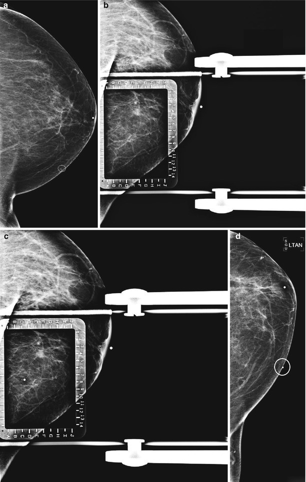 Mammography Techniques, Positioning, and Optimizing Image Quality ...