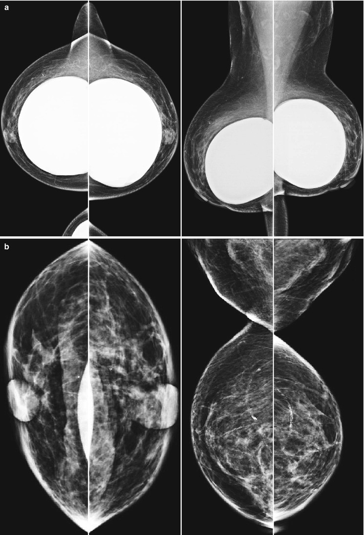 Mammography Techniques, Positioning, and Optimizing Image Quality ...