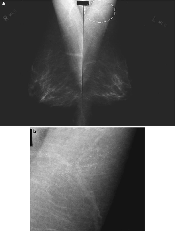Mammography Techniques, Positioning, and Optimizing Image Quality ...