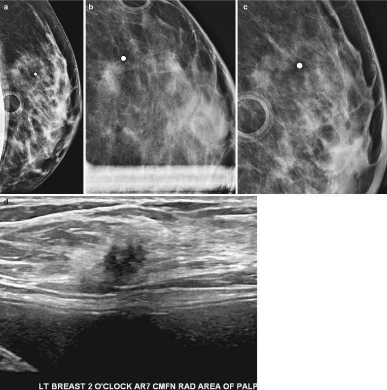 Mammographic Signs of Breast Cancer | SpringerLink