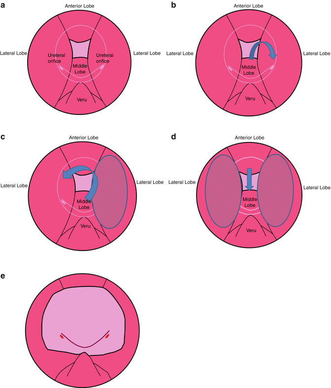 Non-laser Transurethral Resection of the Prostate | SpringerLink