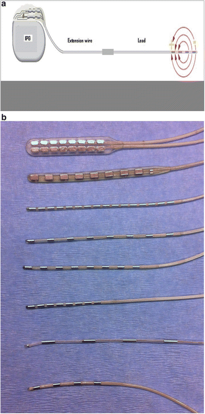 Spinal Cord Stimulation | SpringerLink