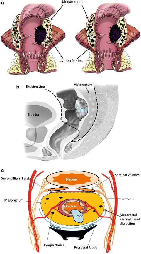 Rectal Cancer | SpringerLink