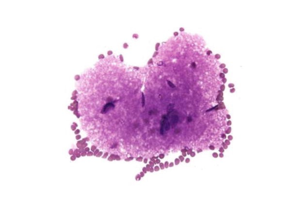Cerebrospinal Fluid (CSF) Cytology | SpringerLink