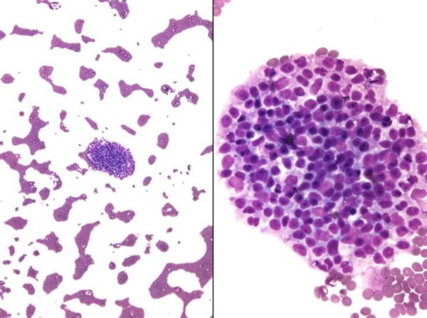 Cerebrospinal Fluid (CSF) Cytology | SpringerLink