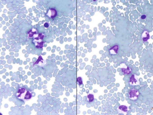 Cerebrospinal Fluid (CSF) Cytology | SpringerLink