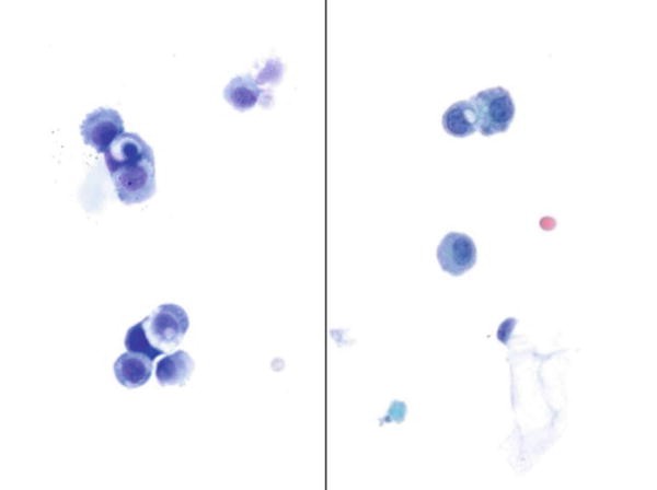 Cerebrospinal Fluid (CSF) Cytology | SpringerLink