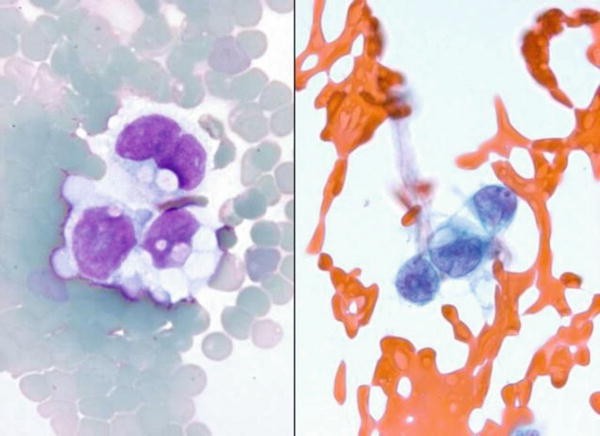 Cerebrospinal Fluid (CSF) Cytology | SpringerLink