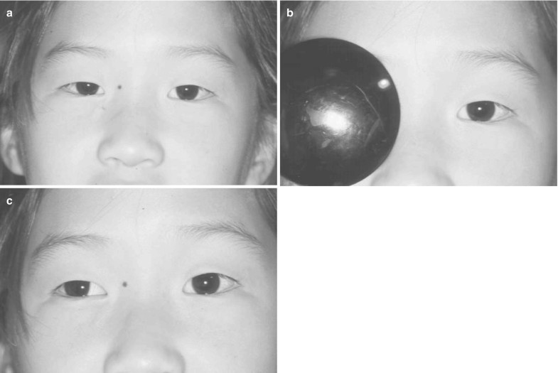 Exotropia | SpringerLink