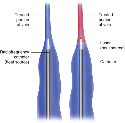 The Vein Stripping Ablation and Phlebectomy | SpringerLink