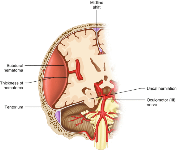Decompressive Craniotomy in Trauma | SpringerLink