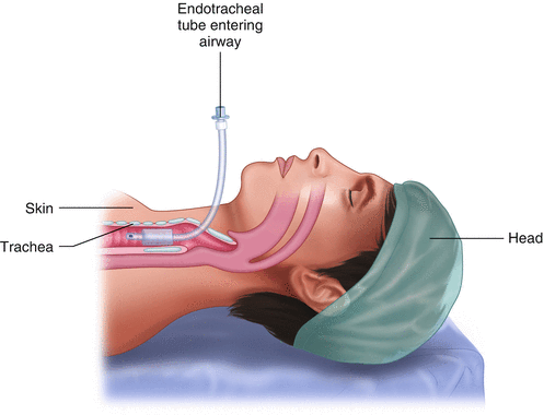 Tracheostomy and Cricothyroidotomy | SpringerLink