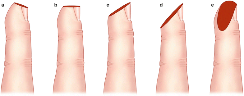 Repair Of Fingertip Amputations SpringerLink repair-of-fingertip-amputations-springerlink
