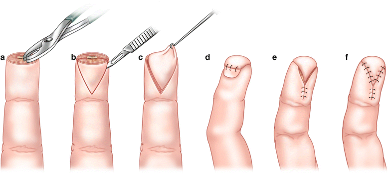 Repair of Fingertip Amputations | SpringerLink
