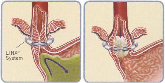Gastroesophageal Reflux Disease | SpringerLink