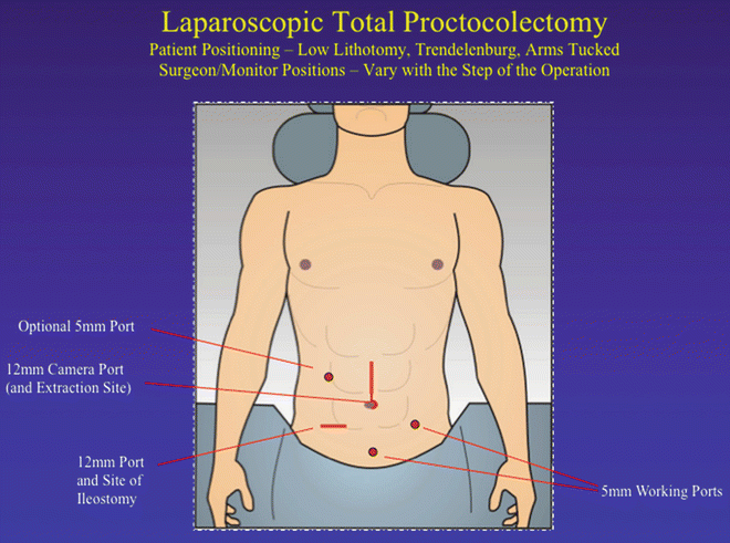 Laparoscopic Proctocolectomy | SpringerLink