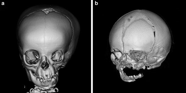 Craniofacial Syndromes with Airway Anomalies: An Overview | SpringerLink