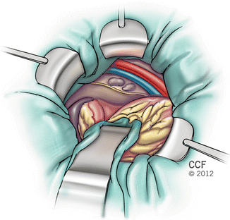 Open Radical Retropubic Prostatectomy and Pelvic Lymph Node Dissection | SpringerLink