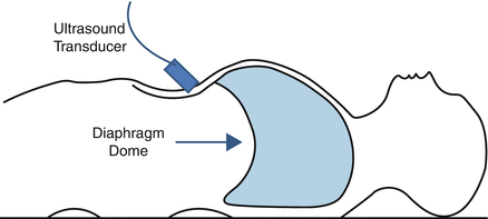 Diaphragm Ultrasound in the Intensive Care Unit | SpringerLink