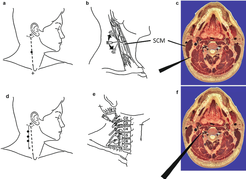 Cervical Plexus Block | SpringerLink