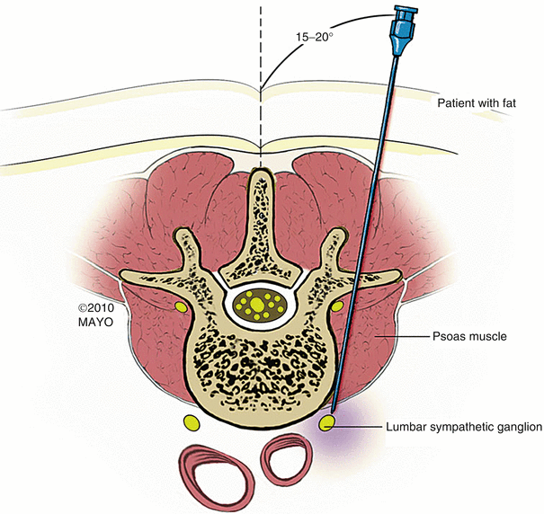 Thoracic and Lumbar Sympathetic Nerve Block and Neurolysis | SpringerLink