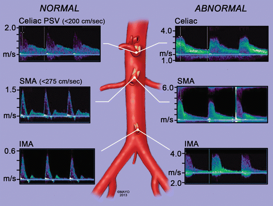 Duplex Ultrasound of the Mesenteric Vessels | SpringerLink