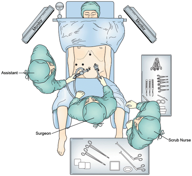 Laparoscopic Pancreaticoduodenectomy | SpringerLink