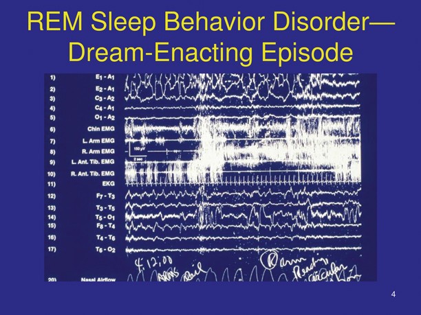 REM Sleep Behavior Disorder | SpringerLink
