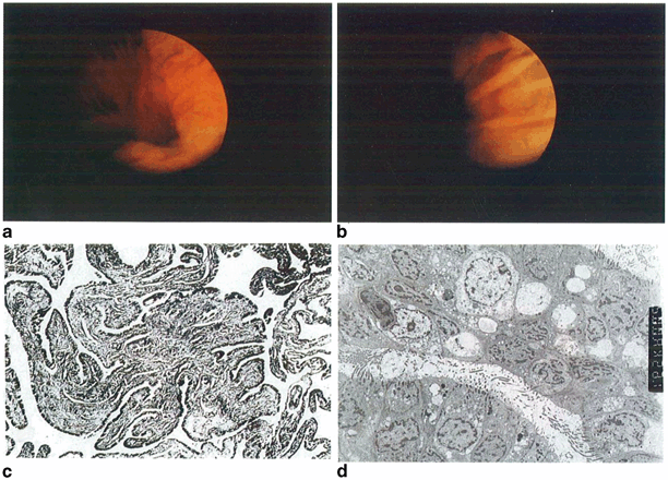 Fallopian Tube Dysfunction in Unexplained Infertility | SpringerLink