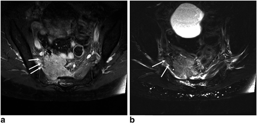 Radiation-Induced Lumbosacral Plexopathy | SpringerLink