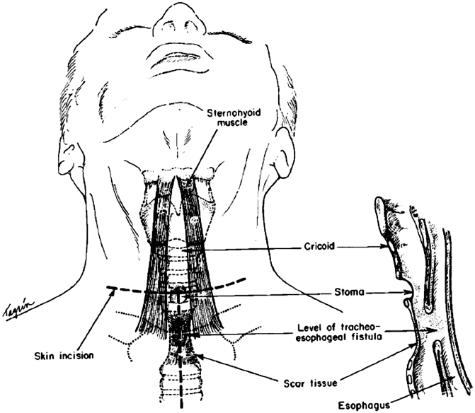 Tracheo-Esophageal Fistula | SpringerLink