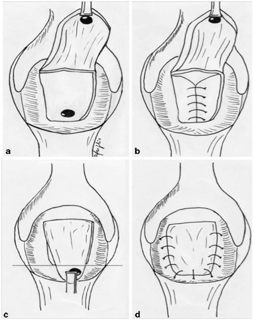 Management of Rectovaginal Fistula | SpringerLink