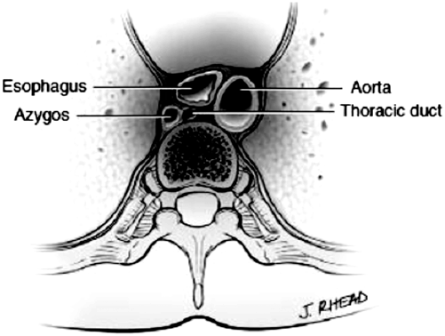 Chyle Leak After Esophageal Surgery | SpringerLink