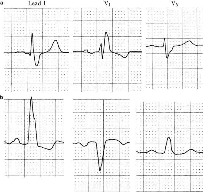 Bundle Branch Blocks and Hemiblocks | SpringerLink