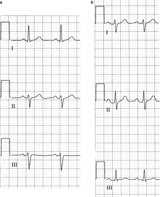 Bundle Branch Blocks and Hemiblocks | SpringerLink
