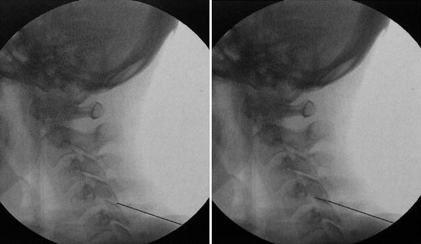 Cervical Injections | SpringerLink