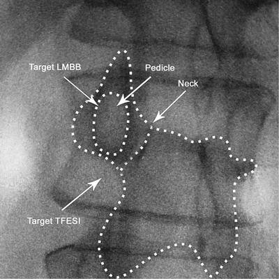 Lumbar Injections | SpringerLink