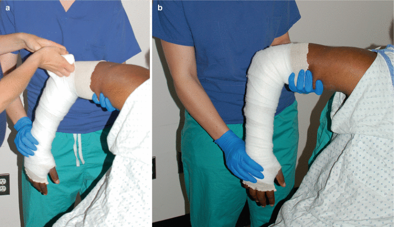 Sugar-Tong Splint | SpringerLink