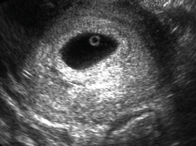 Ultrasonography for Threatened, Incomplete, or Compete Abortion ...