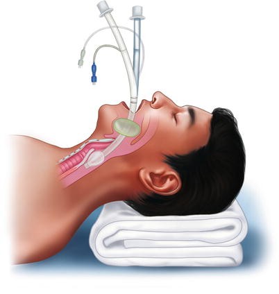 Combitube | SpringerLink