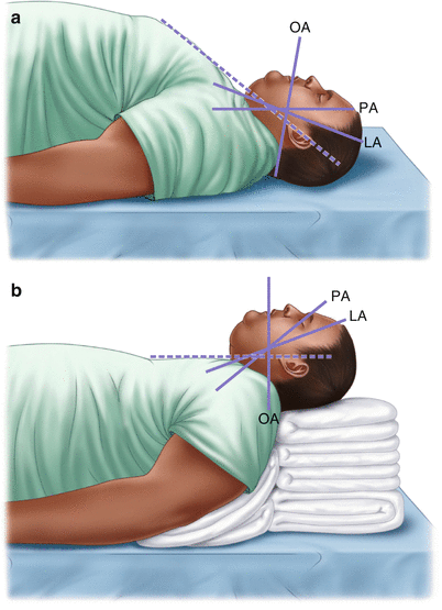 Assessment of the Difficult Airway | SpringerLink