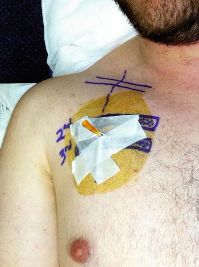 Needle Thoracostomy | SpringerLink