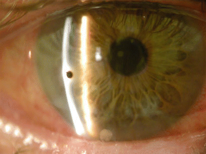 Corneal Foreign Body Removal | SpringerLink